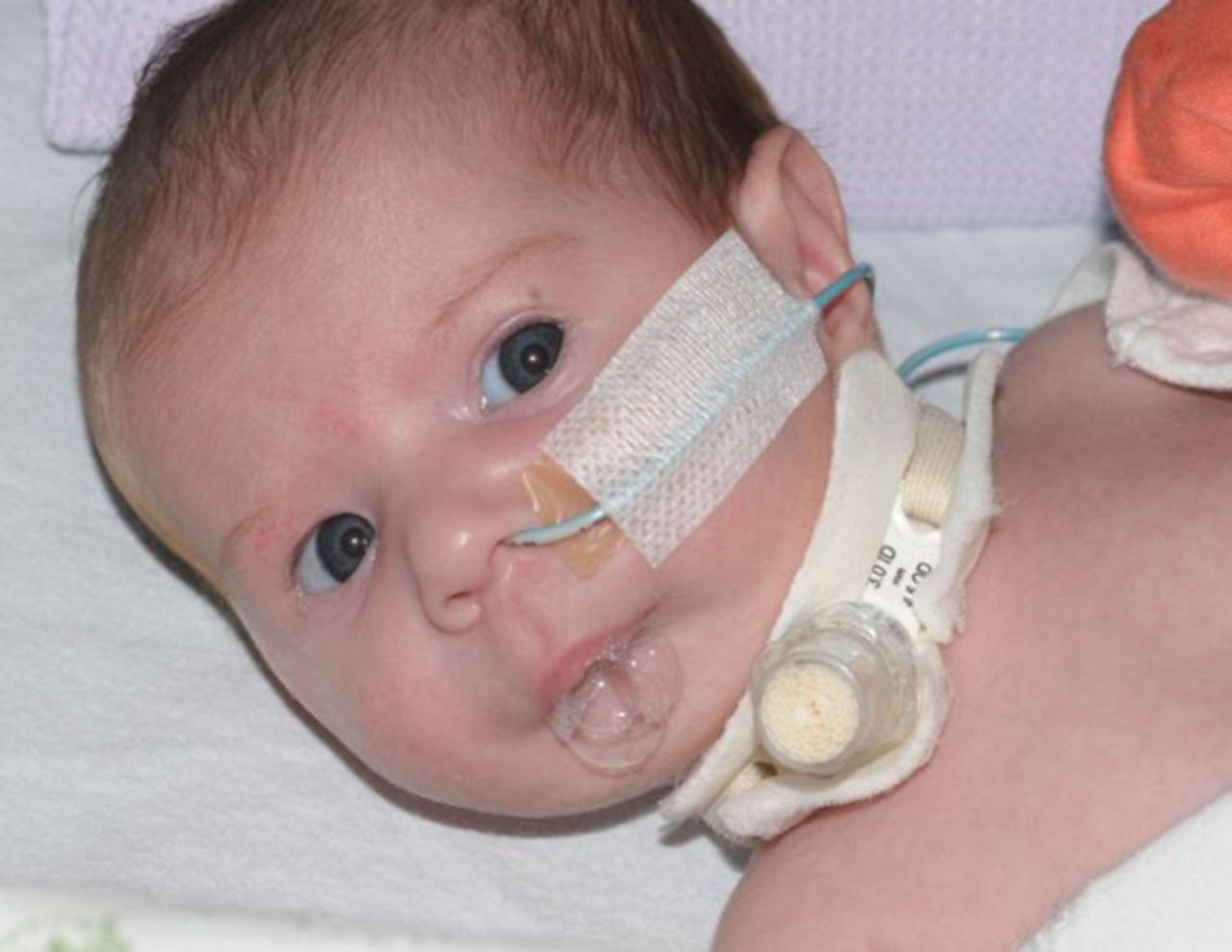Pediatric Tracheostomy (trach) Care: Crucial Instructions - Golden ...